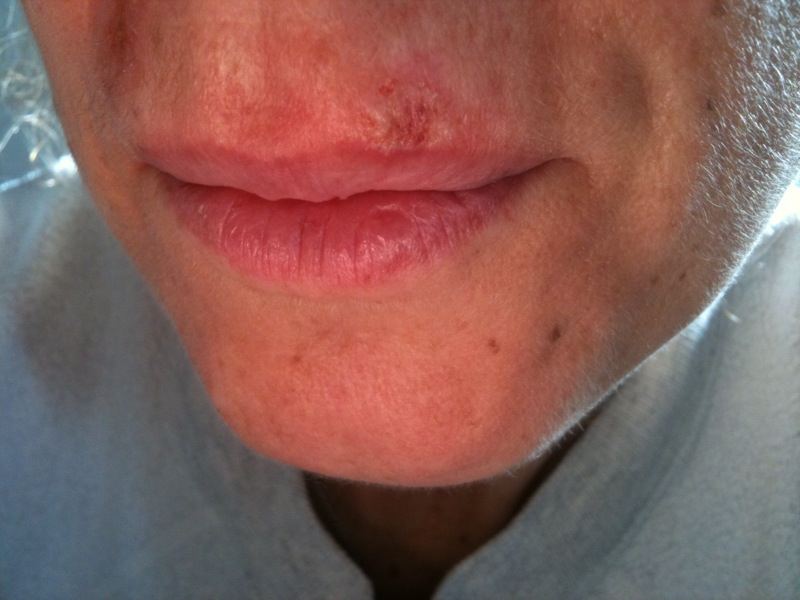 Skin Cancer Forum