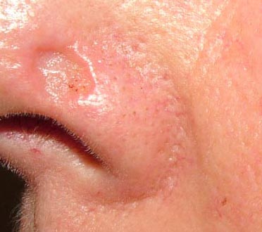 Sudden-indentation-on-nose BEST